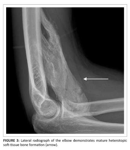 Myositis Ossificans - New