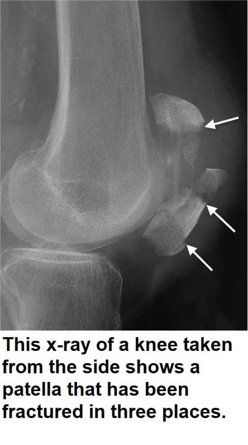 Fractures Of The Patella - New