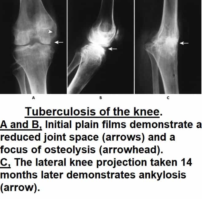 TUBERCULOSIS OF KNEE - www.medicoapps.org