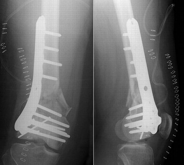 Fracture Shaft Of Femur - New
