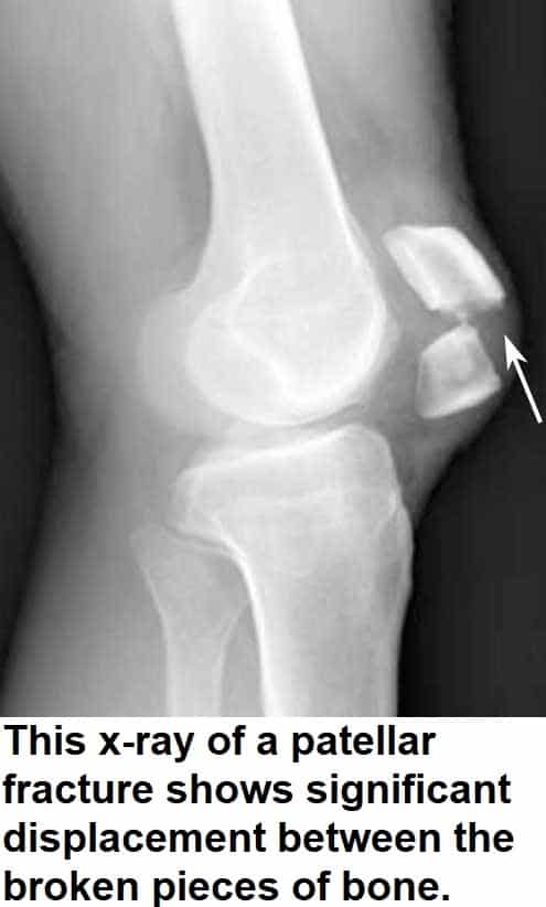 Fractures Of The Patella - New