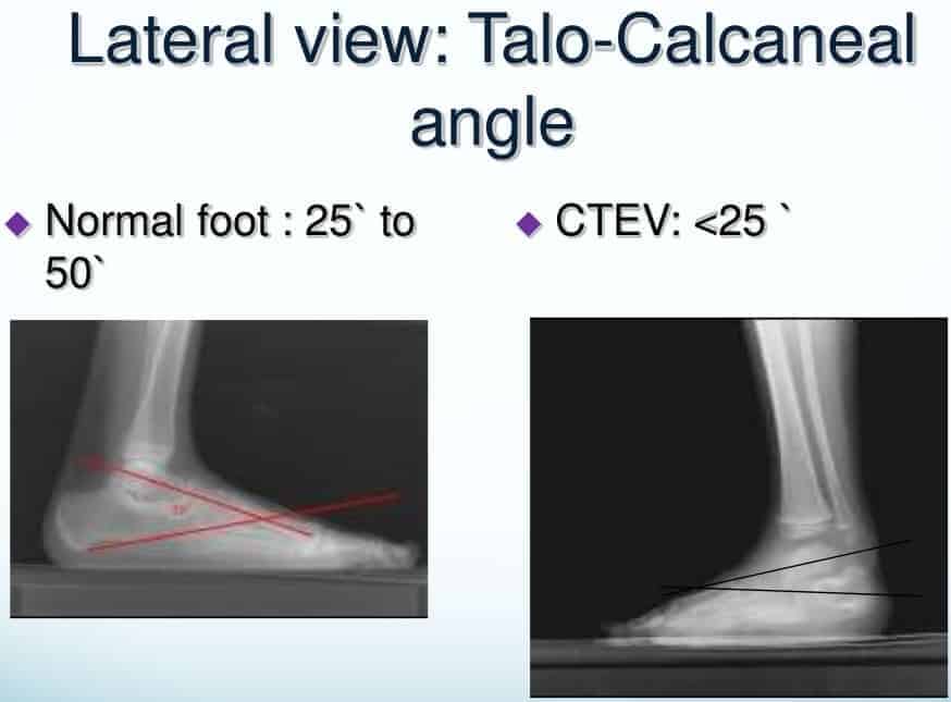 Congenital Clubfoot - New
