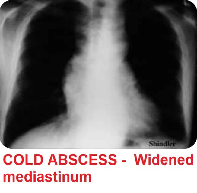 TUBERCULOSIS OF SPINE (Pott's disease) - New