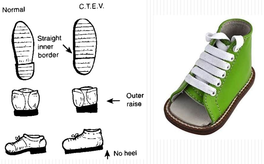 CONGENITAL CLUBFOOT - New