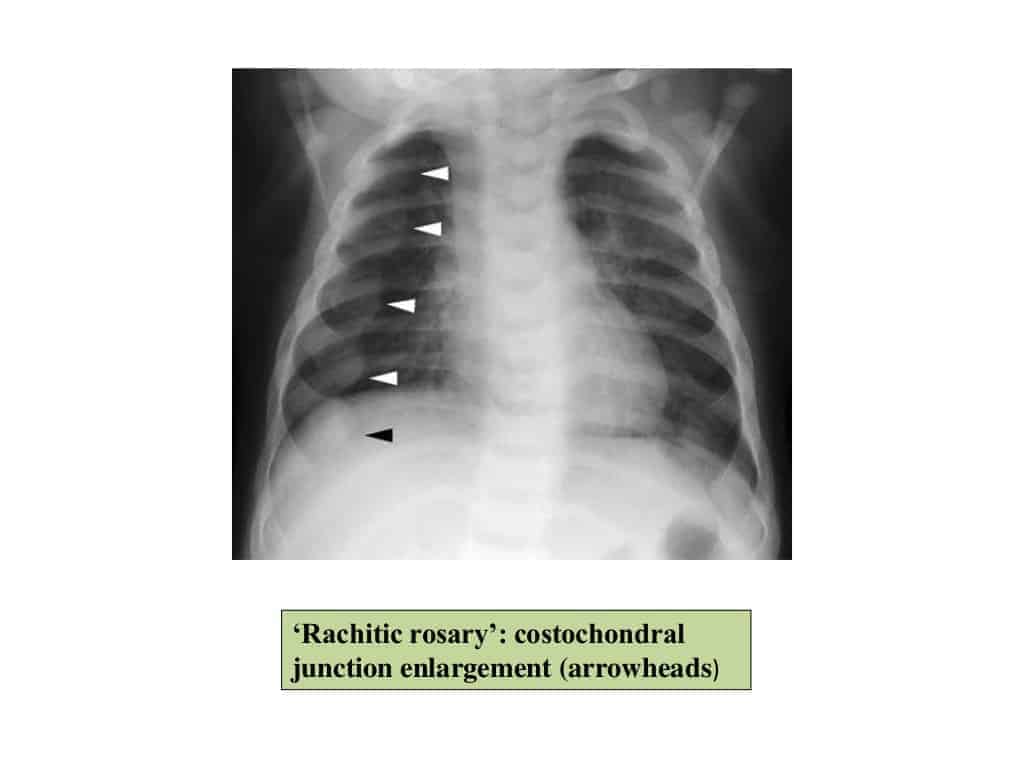 RICKETS - www.medicoapps.org