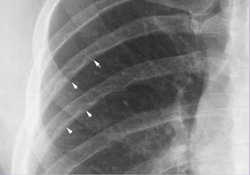 RIB NOTCHING - www.medicoapps.org
