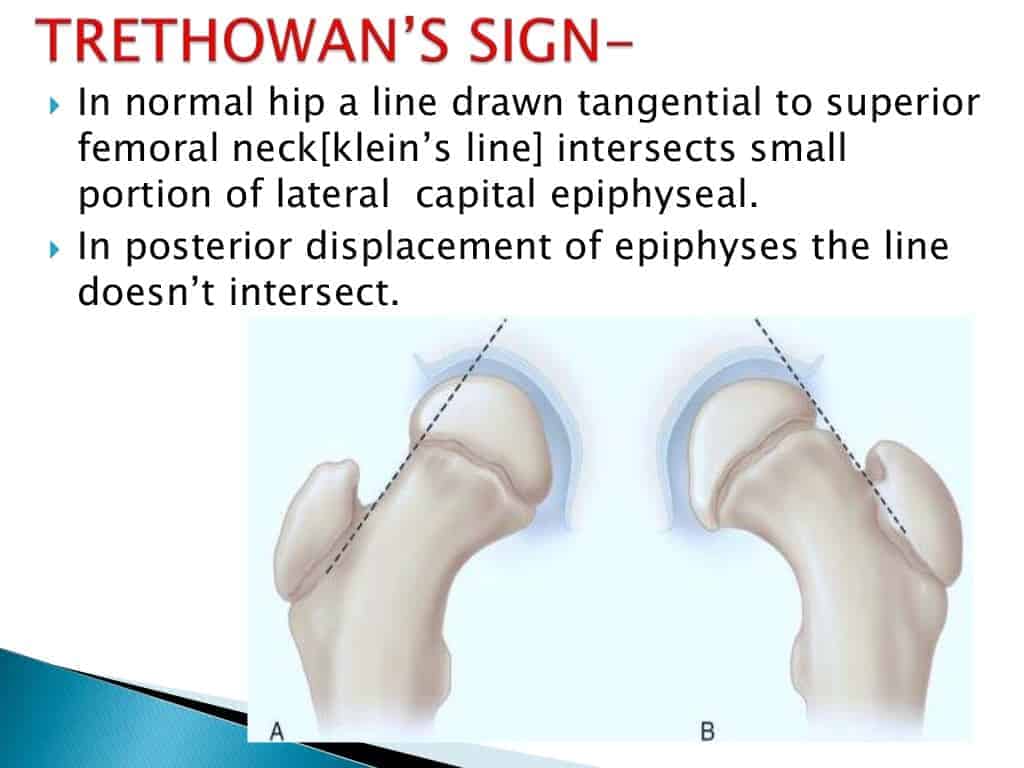 Slipped Capital Femoral Epiphysis (Scfe) - www.medicoapps.org