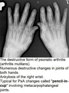 med_x_ray_of_hands_the_destructive_form_of_psoriatic_arthritis ...