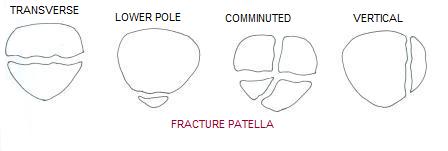 FRACTURES OF THE PATELLA - New