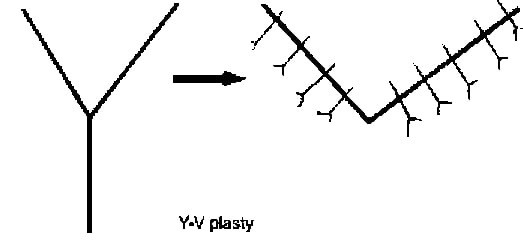 Y-V plasty - New