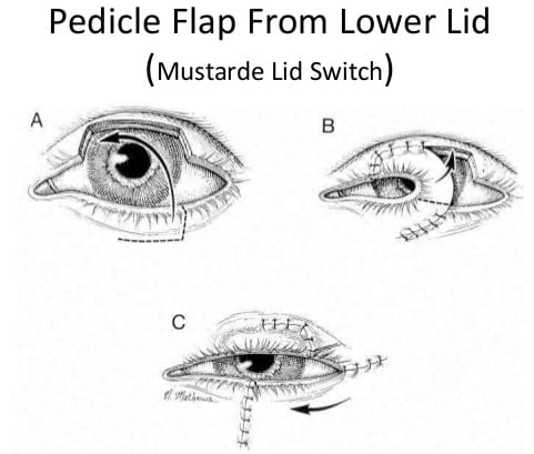 lower eyelid pedicle flap - New
