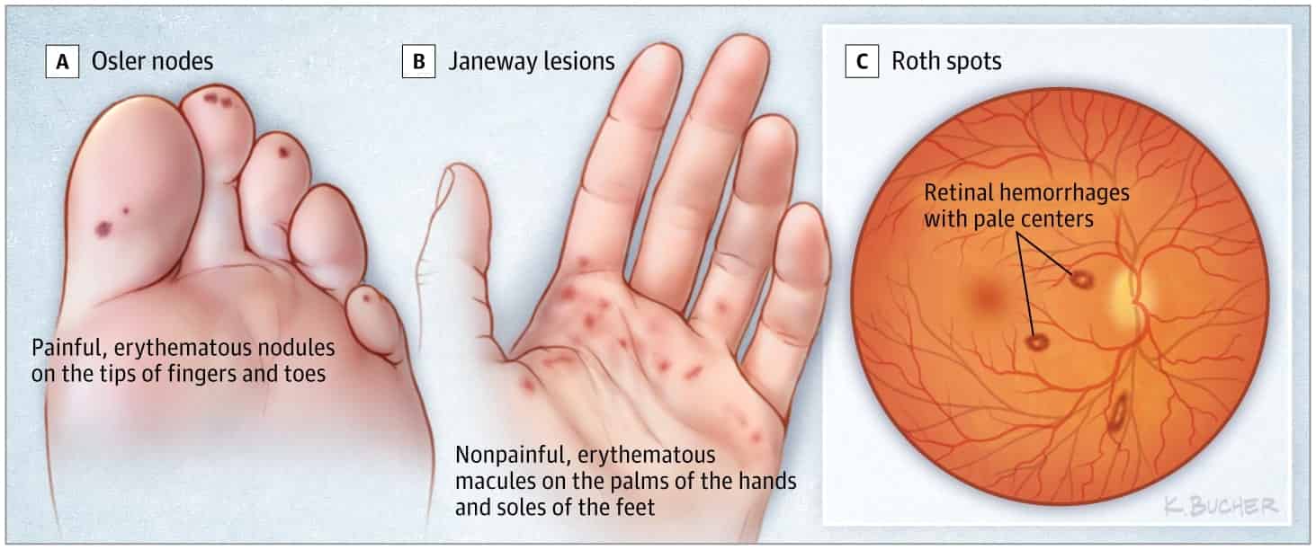 med_infective_endo - New