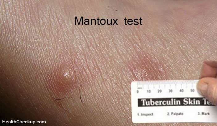 med_mantoux_test - New