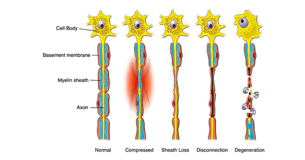 Nerve Injuries - New