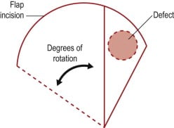 rotational flap - New
