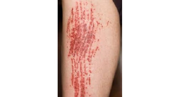 Abrasion - www.medicoapps.org