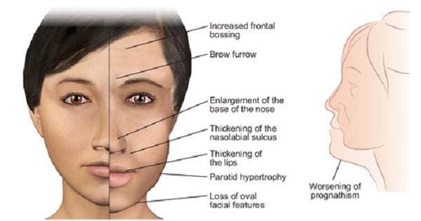Acromegaly - www.medicoapps.org