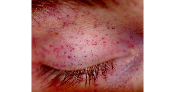 Asphyxial Death Archives - New