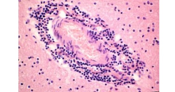 Chronic inflammation - www.medicoapps.org