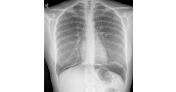 Gastric ulcer Radiological features - New