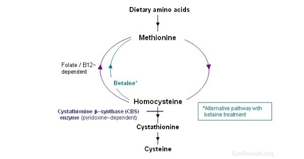 Homocystinuria - New