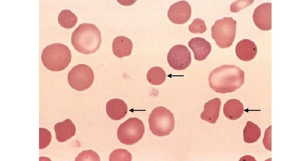 Hereditary spherocytosis - www.medicoapps.org