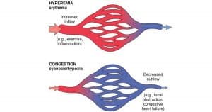 Hyperemia & Congestion - New