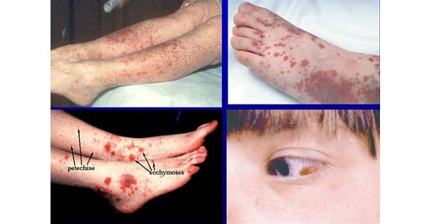 Idiopathic Thrombocytopenia Purpura (Itp) - www.medicoapps.org