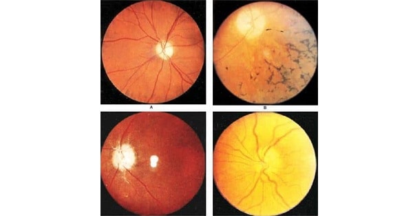 Optic Atrophy - New