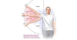 Painful Arc Syndrome - New