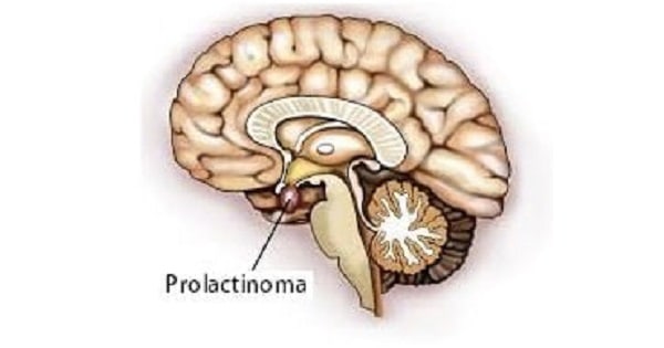 Prolactinomas - New