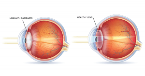 SENILE CATARACT- Pathophysiology, Symptoms, Complications - New