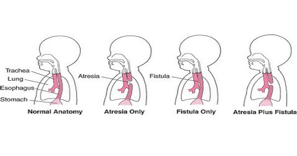 Tracheo-Oesophageal Fistula - New