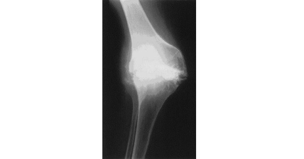 Tuberculosis Of Knee - New