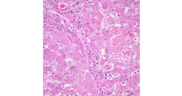Alpha-1 Antitrypsin Deficiency - New
