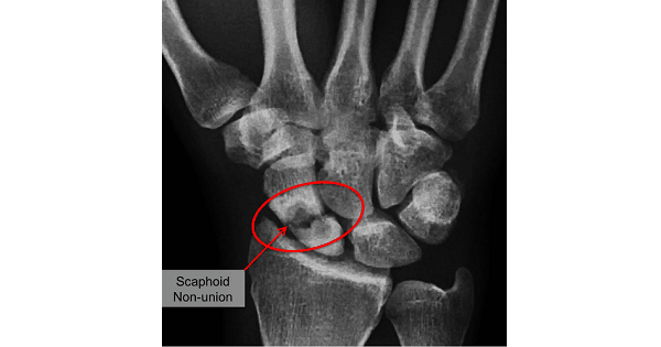 Scaphoid Fracture - New