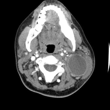 Branchial Cyst - New