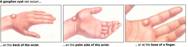 Ganglion Cyst - New