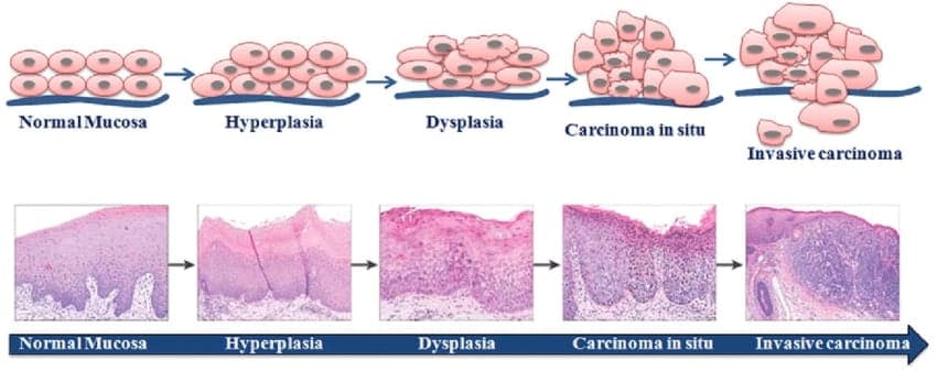 Stages-of-oral-cancer-progression - New