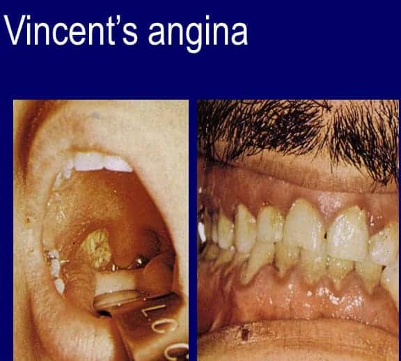 Vincent Angina - www.medicoapps.org