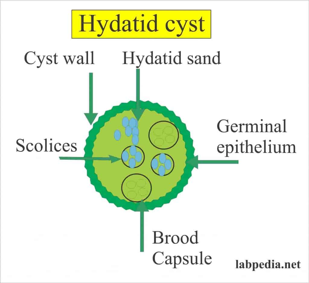 hydatid cyct - New