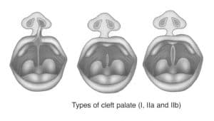 palate types - New