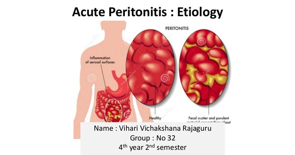Peritonitis