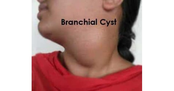Branchial Cyst - New