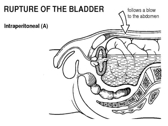 Intraperitoneal - New