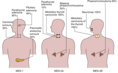 Multiple Endocrine Neoplasia (Men) - New