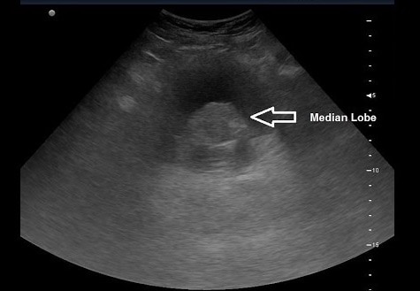 BENIGN PROSTATIC HYPERPLASIA - New