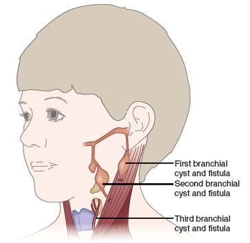 BRANCHIAL FISTULA - New