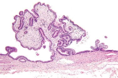 CHOLESTEROLOSIS - New