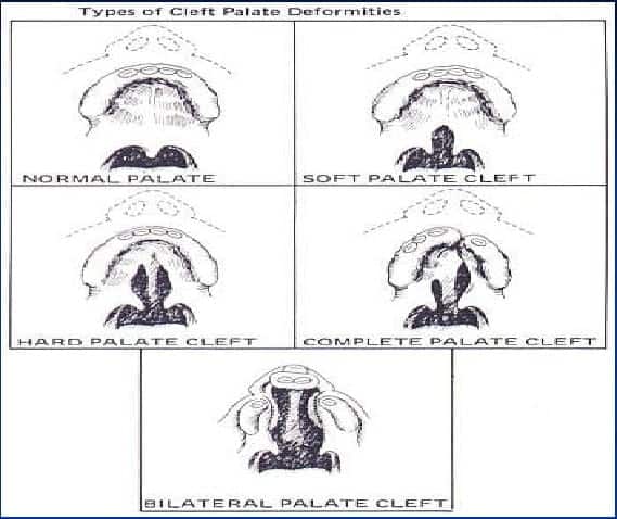 CLEFT PALATE - www.medicoapps.org
